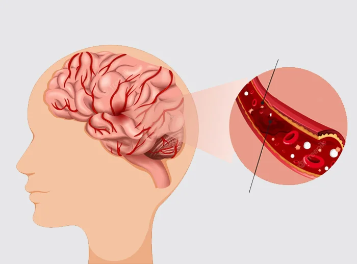 Ischemic Stroke: Causes, Symptoms and Treatment